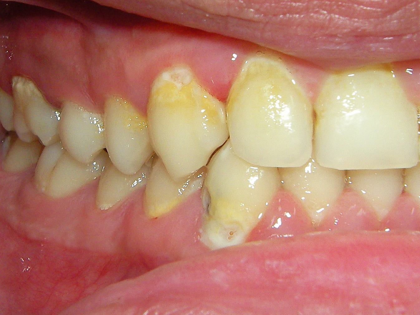 Was ist Zahnbelag? - Gute Gesunde Zähne